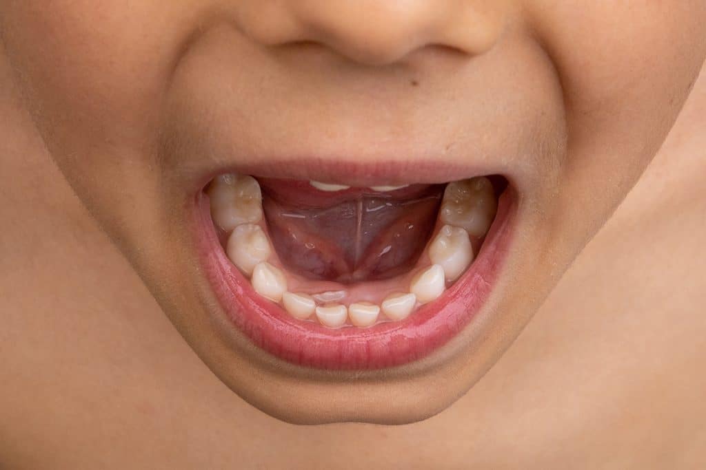 Tooth Eruption & Shedding: What Parents Should Know - Dream Smiles ...