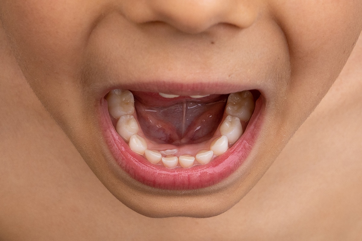 Tooth Eruption & Shedding: What Parents Should Know - Dream Smiles ...